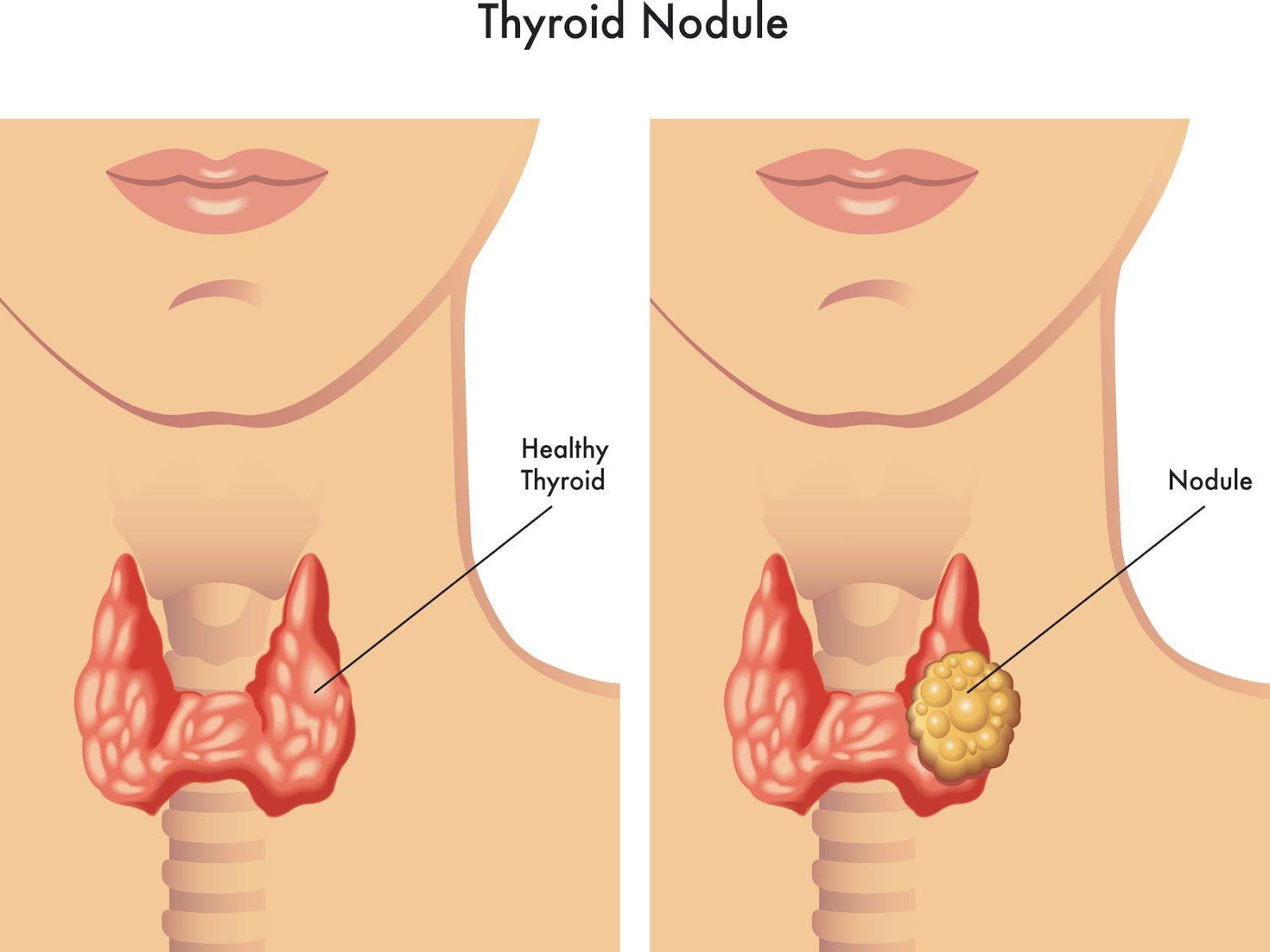 What Causes Thyroid Nodules To Grow? What Causes Thyroid Nodules To Grow?