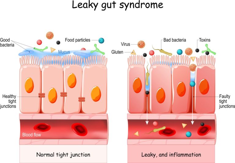 How To Use Leaky Gut Supplements To Target Inflammation