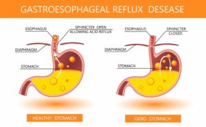 Identifying 'Silent Reflux' or LPR Symptoms and Causes