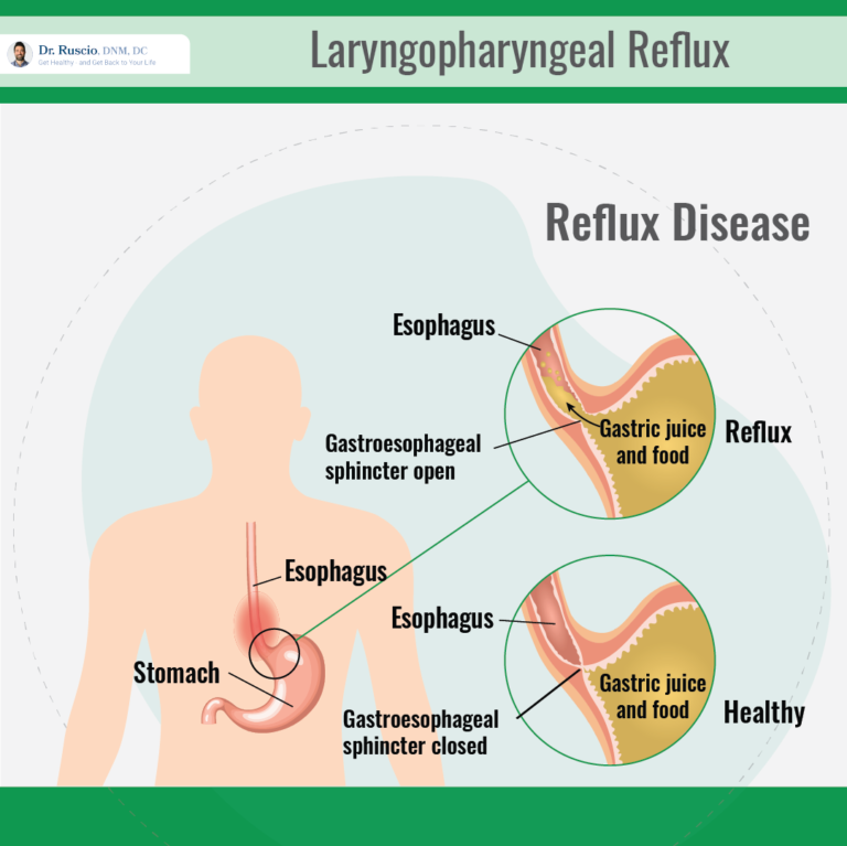 How to Identify and Treat Laryngopharyngeal Reflux (LPR)