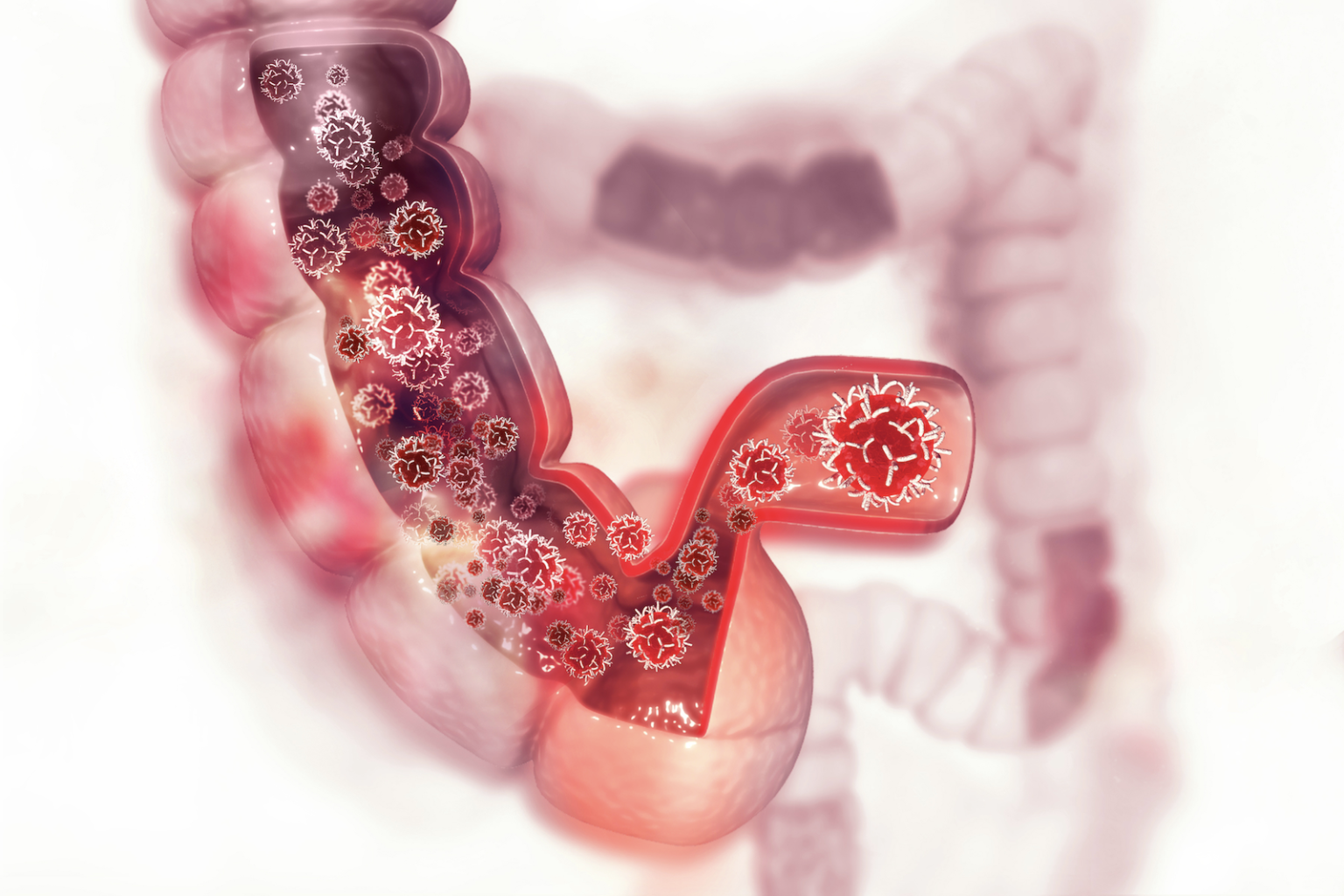 Effective Colon Pain Management and Treatment Options