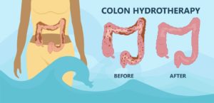 Does Colon Hydrotherapy Work? Behind the Risks vs. Benefits
